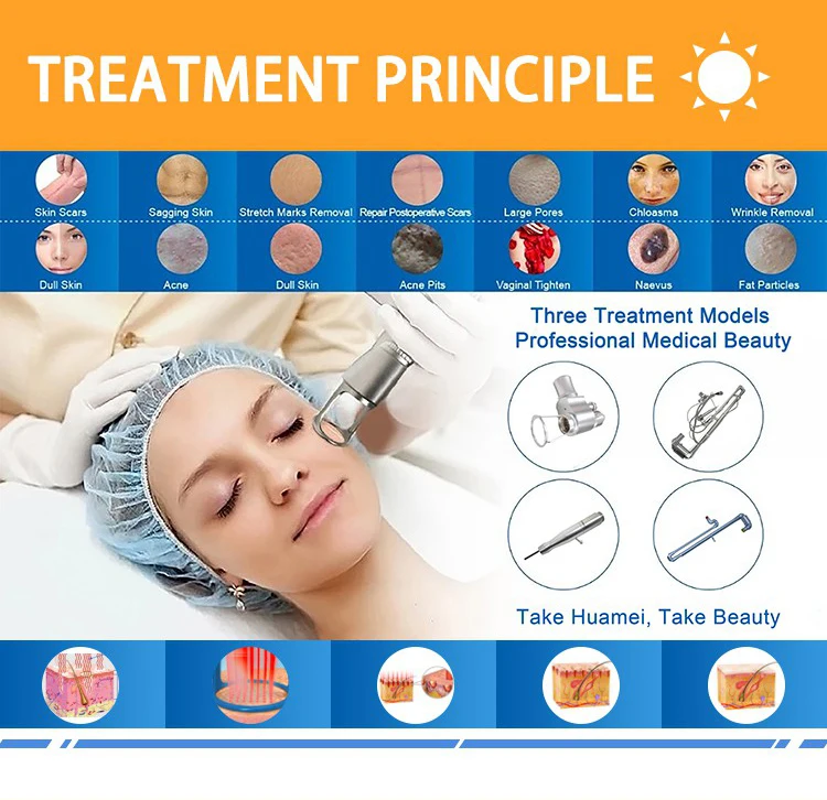 Fotona CO2 Laser for Stretch Marks - Scar Removal & Vaginal Tightening