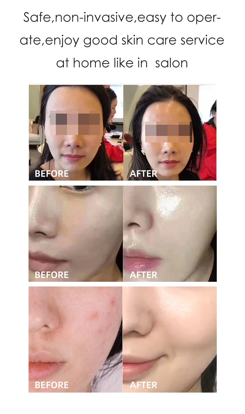 Mesotherapy Hyaluronic Injector Gun Filler Filling Serum Injection Pen ...