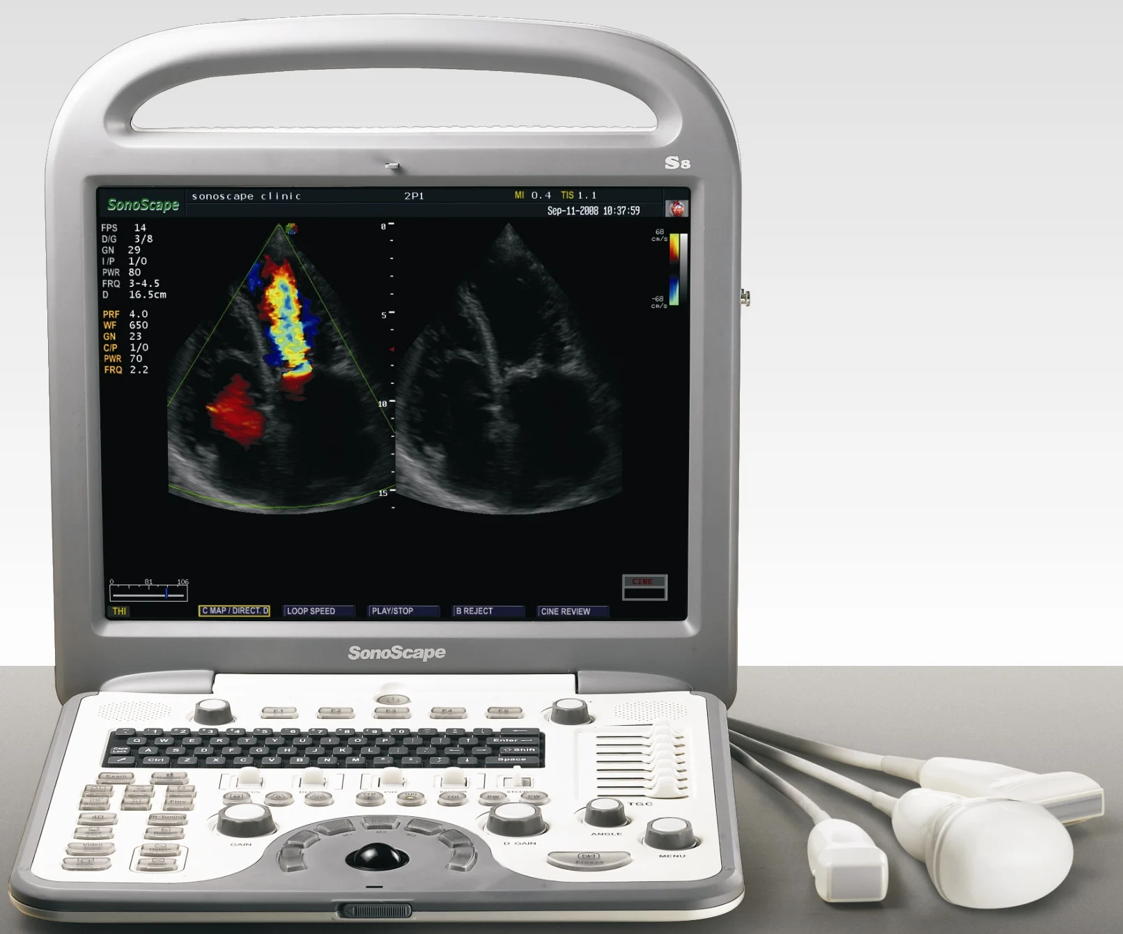 Sonoscape Ultrasound Review - Sonoscape S8 Performance