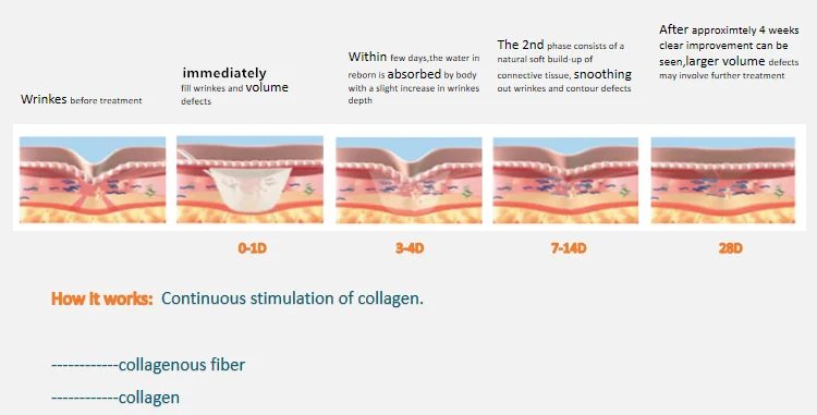 360mg Plla Powder New Dermal Filling For Face Breast Neck Hand - Buy ...