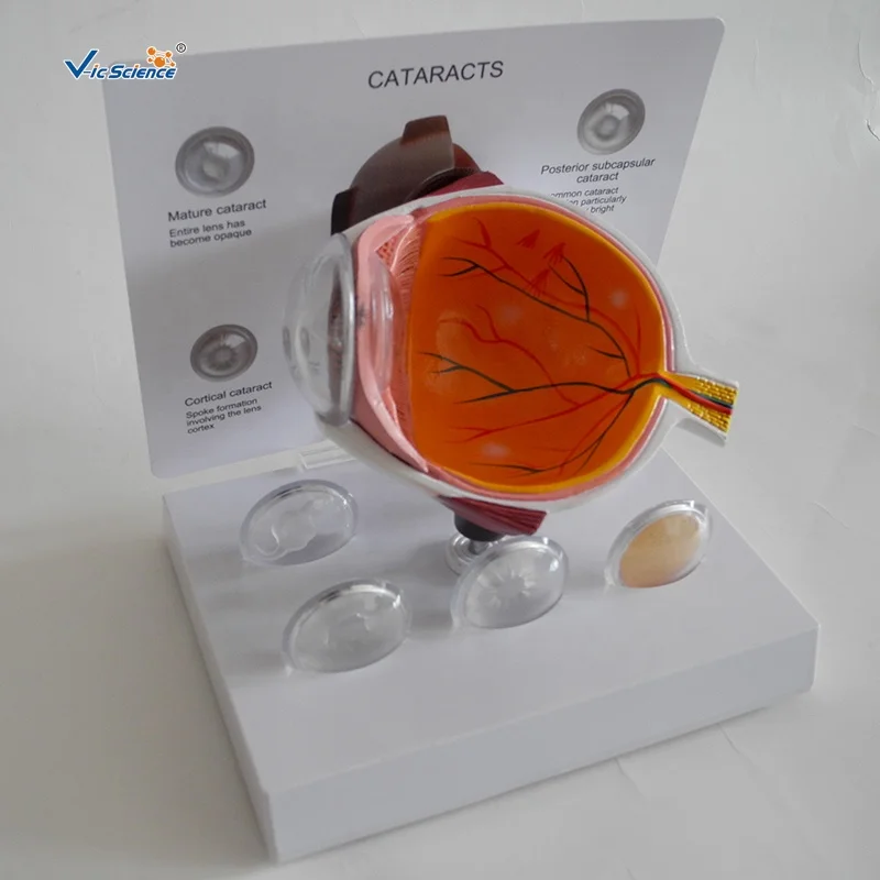 Human Eyeball Cataract Anatomy Model for Medical Education
