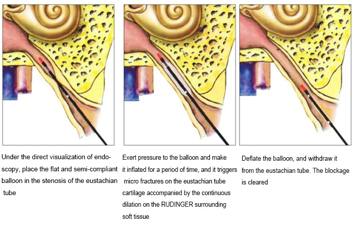 Ent Surgical Device Eustachian Tube Balloon Dilation Cathether - Buy ...