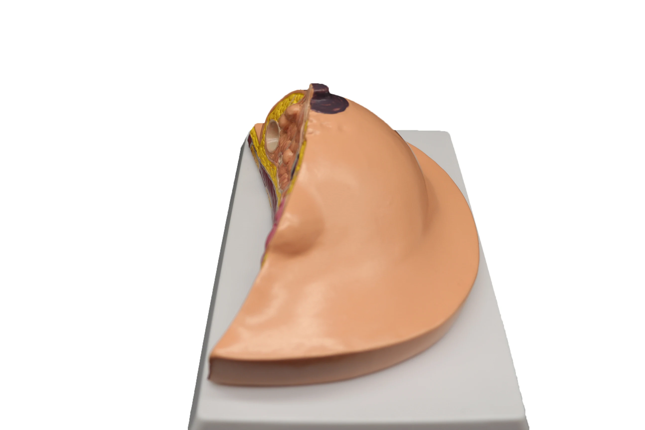 Anatomical Model of Female Breast Cancer - Pathological Medicine