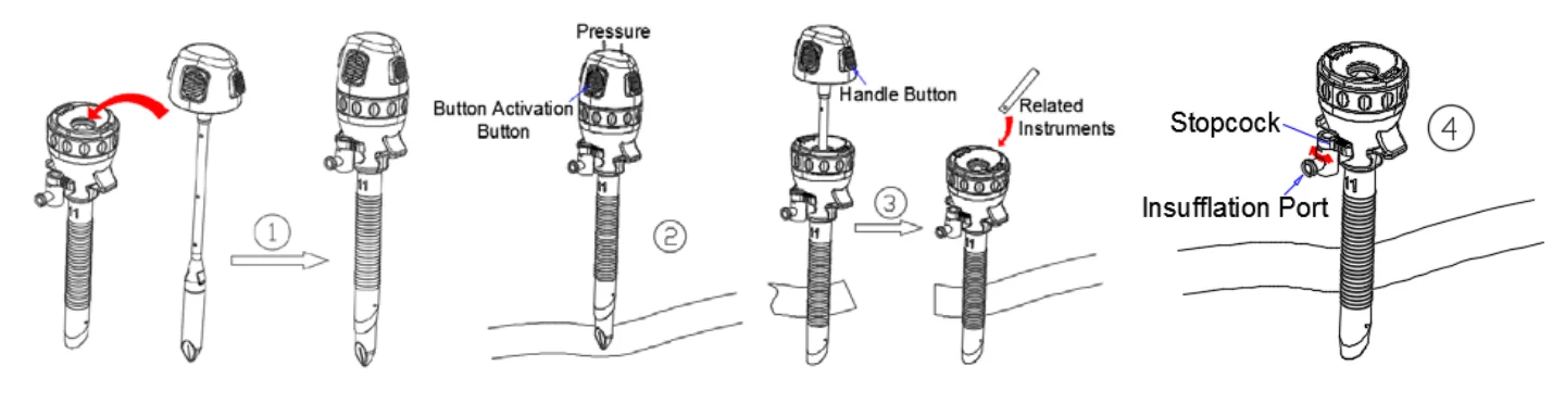 Optical Trocars | Enmind| China | Bladeless Direct Optical Trocar ...