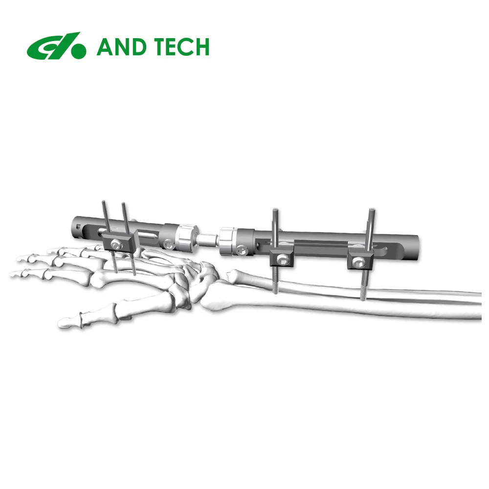 Wrist Fixator Orthopedic External Fixation - Buy Wrist Fixator ...