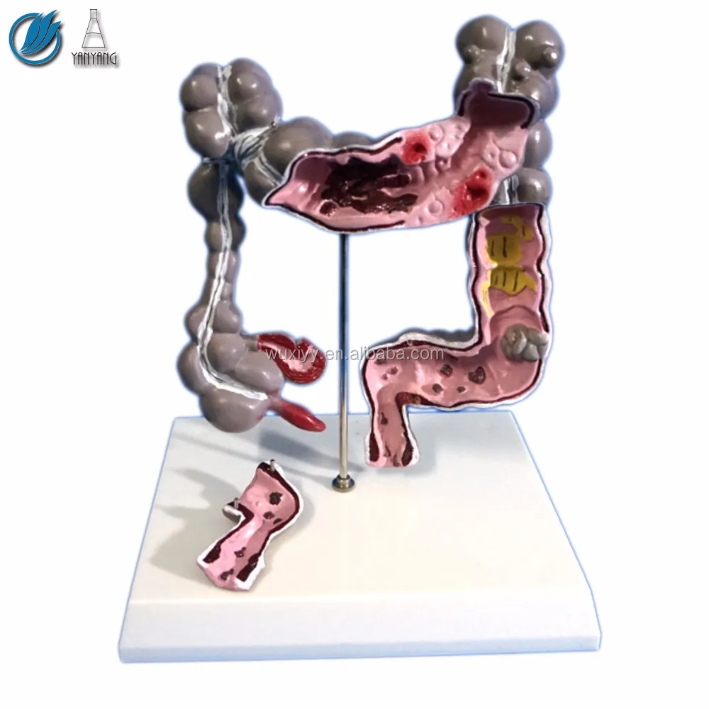 Human Common Pathologies of Colon and Rectum Model - Anatomical ...