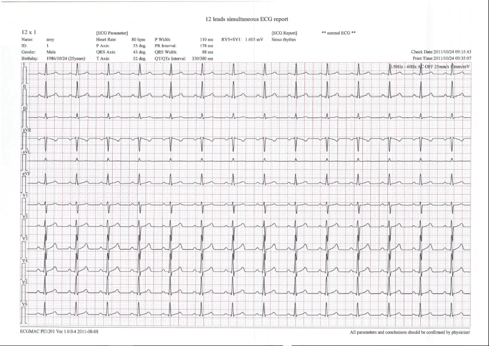 Pc Ecg/ekg Machine Compatible With Windows 10 System - Buy Pc Ecg,Pc ...