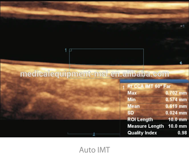 Mindray DC60 - Advanced 4D Color Doppler Ultrasound