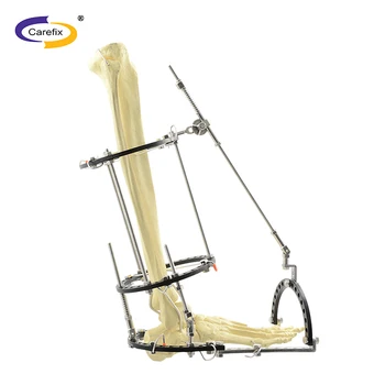 Orthopeidc Ilizarov Steel External Bone Extended Pin Fixation For Limbs ...