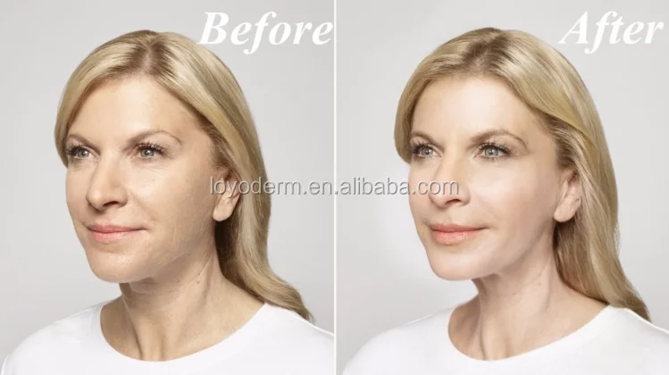 Loyoderm 20ml Dermal Filler Injection Butt Enlargement With Bdde ...