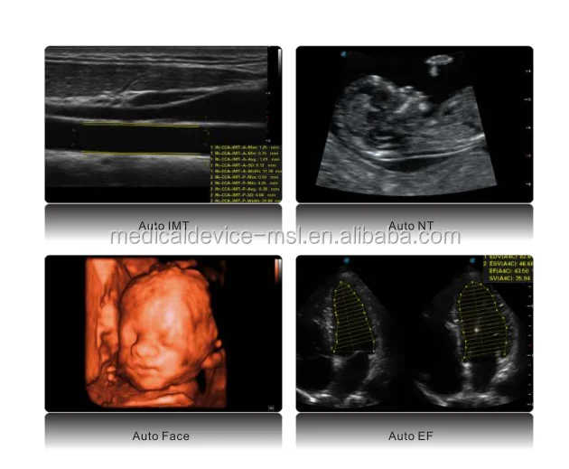 Sonoscape P50 Ultrasound Machine with Color Doppler Echo Detection ...