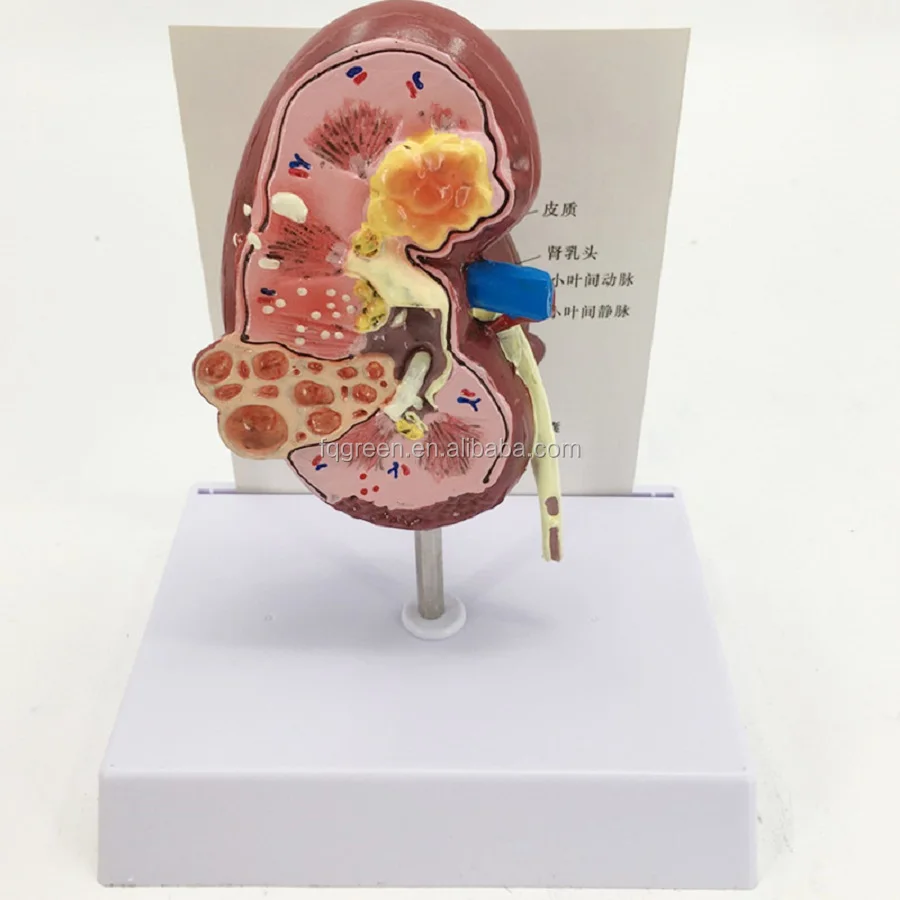 Dissection Model of Kidney and Cyst - Green Medical Training