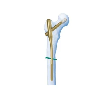 Titanium Bone Fracture Interlocking Nail - Buy Femur Interlocking Nail ...
