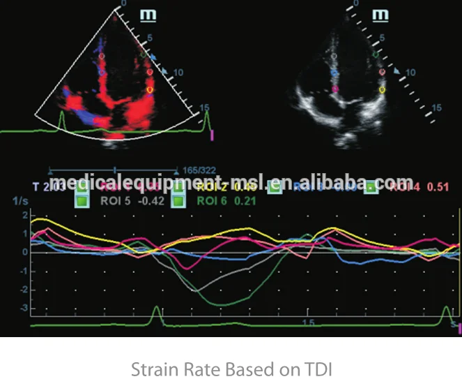 Mindray DC60 - Advanced 4D Color Doppler Ultrasound