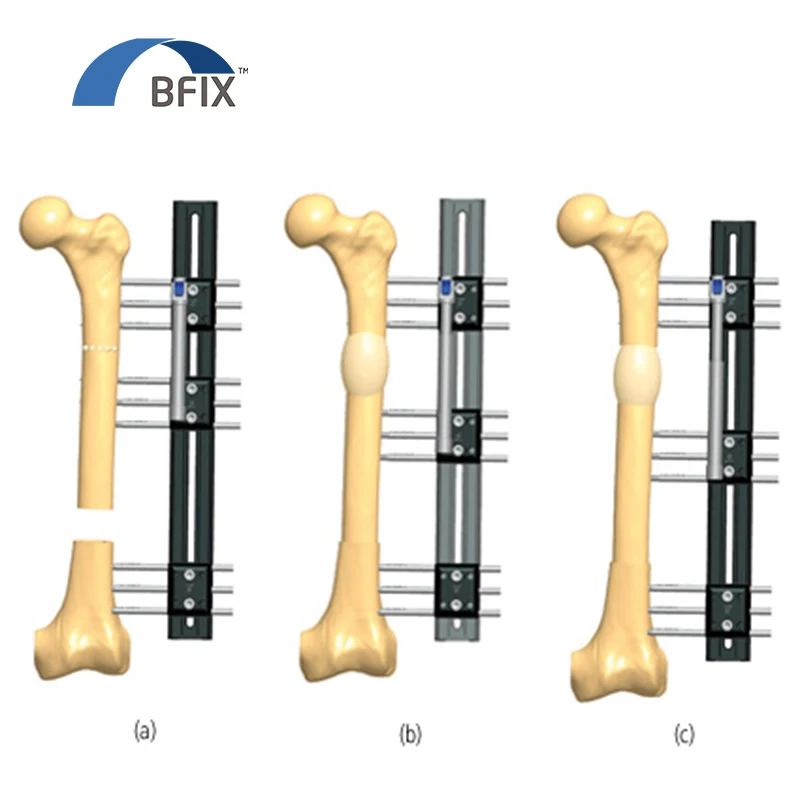 Large Distal Defect In The Femur Lrs Fixator In Place Proximal ...