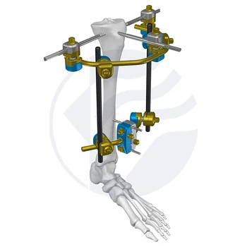Ce Carbon Fiber Tibial Fixator External Fixation System Orthopedic ...