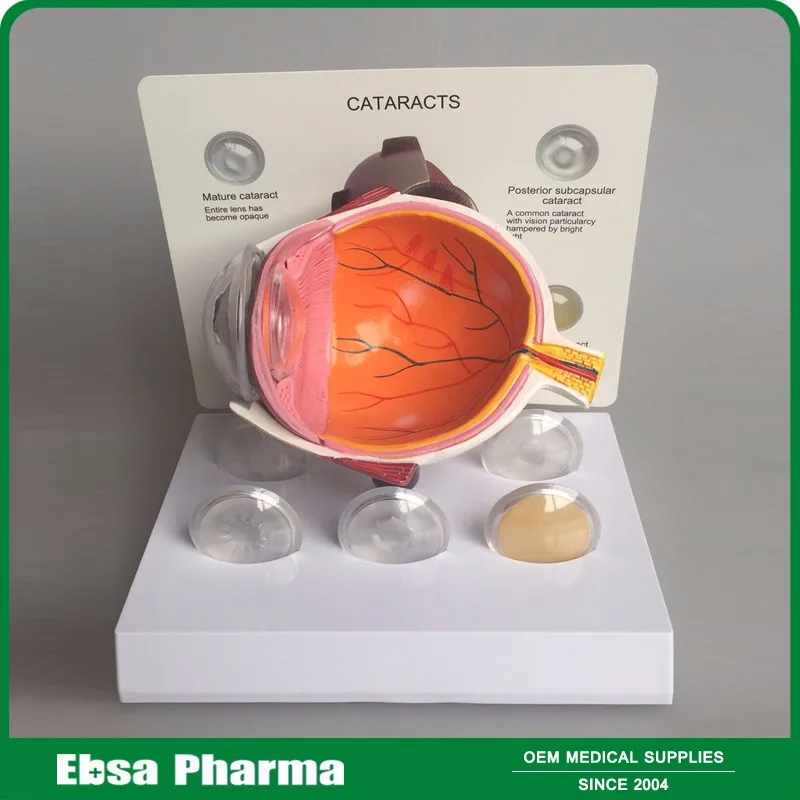 Advanced Medical Supplies - Human Plastic Cataracts Eye Model