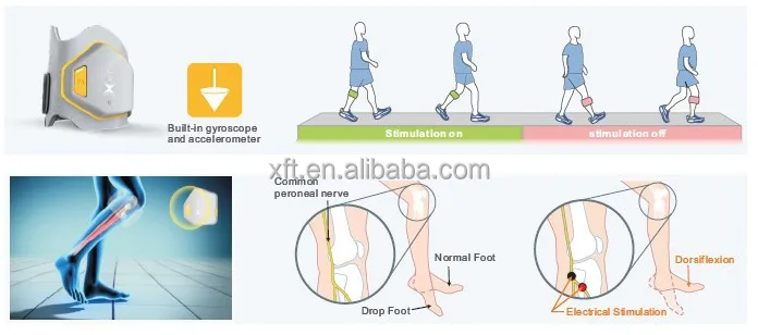 Drop Foot Treatment Device For Peroneal Nerve Palsy - Buy Foot Drop ...