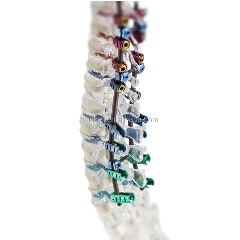 Anterior Cervical Plate Orthopedic Spinal Implant Screws - Buy Anterior ...
