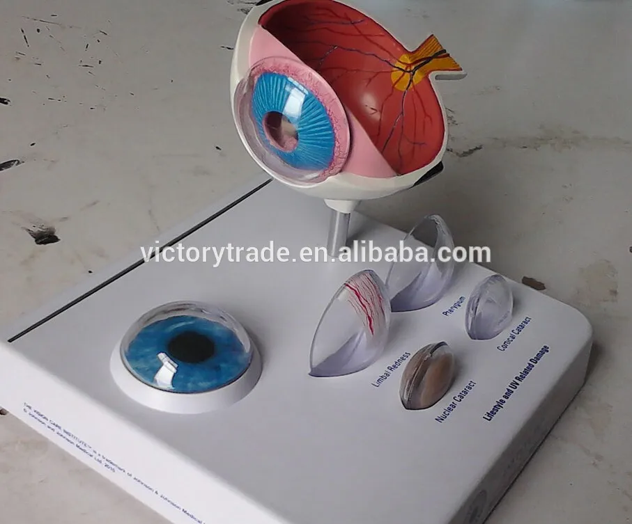V-am029 Plastic Human 3d Cataracts Anatomical Eye Model With 5 ...