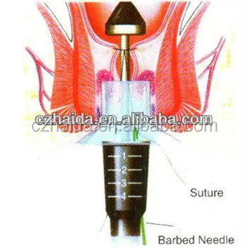 Disposabblle Pph 33mm Circular Hemorrhoids/ Hemorrhoidal Stapler - Buy ...