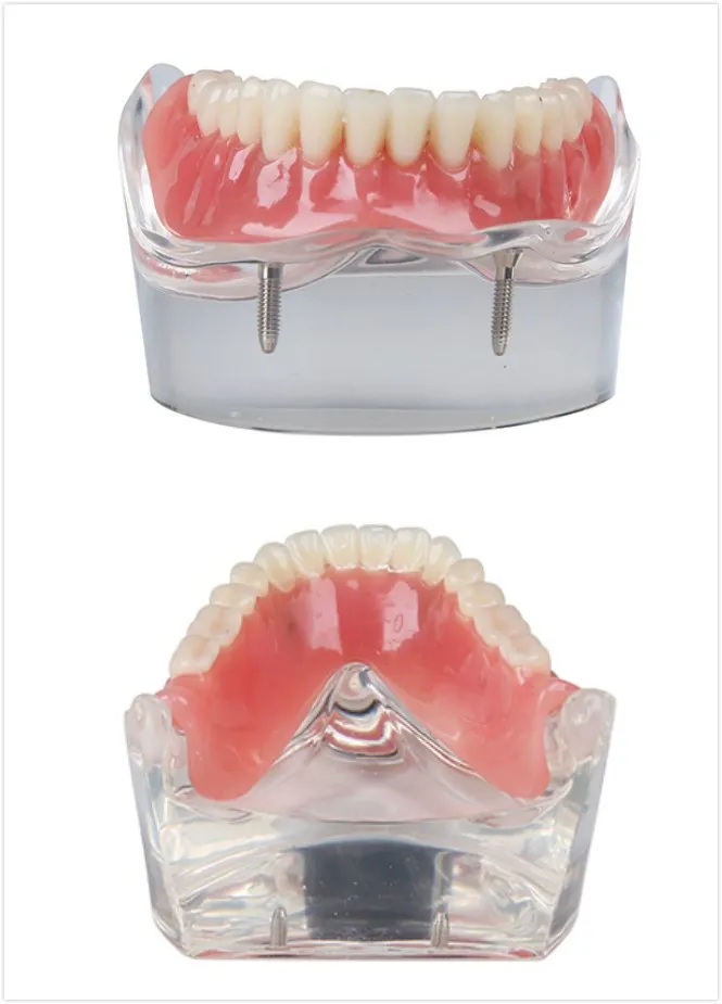 Dental Overdenture Model - Mandibular Lower with 2 Implants