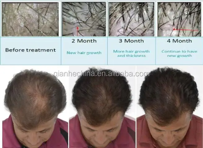 Wholesale Price 650nm Laser Diode Hair Growth Electric Scalp Stimulator ...