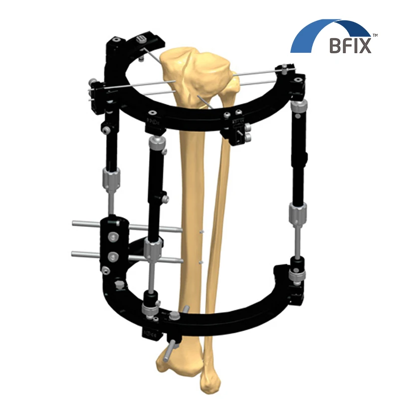 Gelenk Fraktur Der Proximalen Tibia,Behandelt Mit Dem Sheffield Ring ...