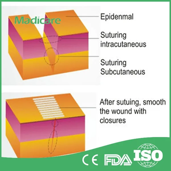Adhesive Reinforced Skin Wound Closure Strips ,Wound Skin Closures ...