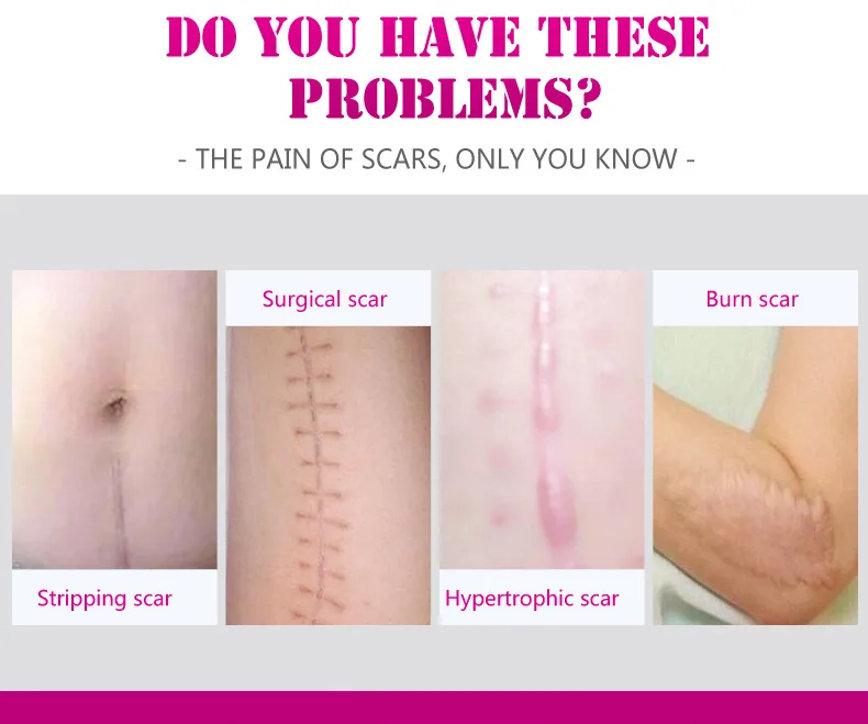 Tyjr Natural Chinese Medicine Postpartum Obesity Pregnancy Stretch ...