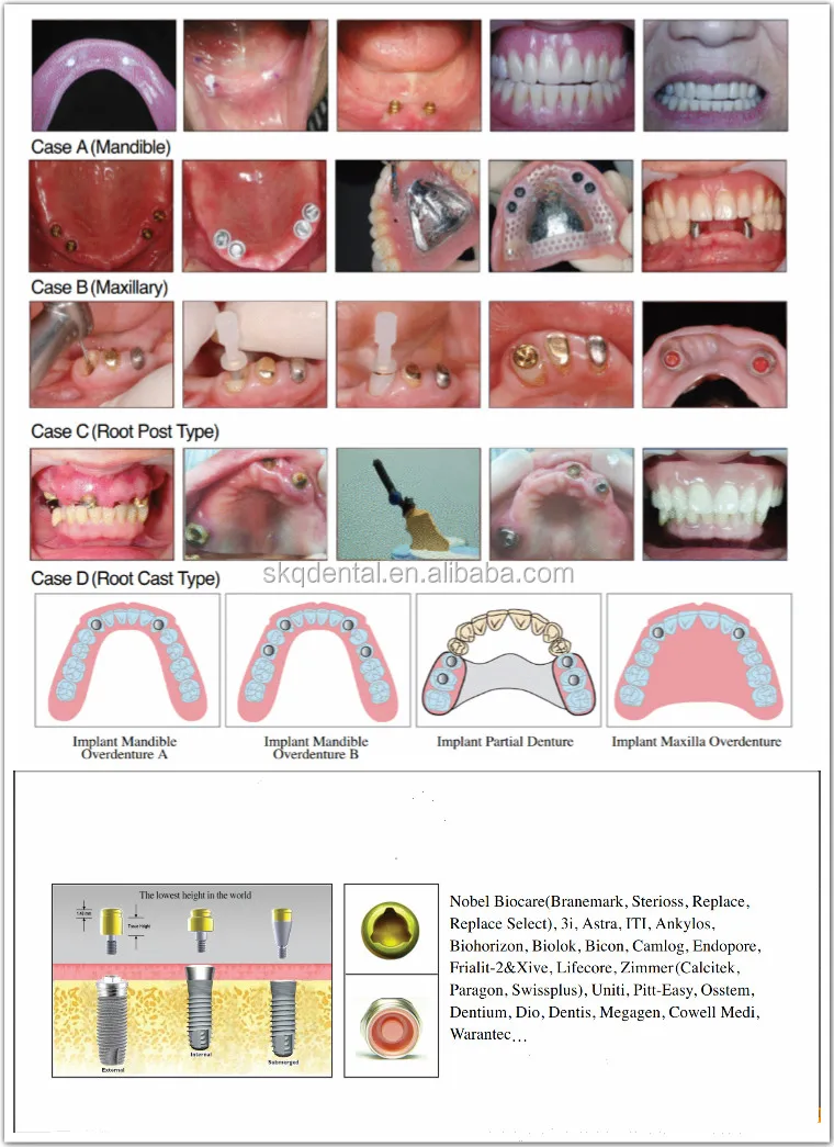 Dental Implant Scan Body,Osstem Scan Body,Dentium Scan Body - Buy ...