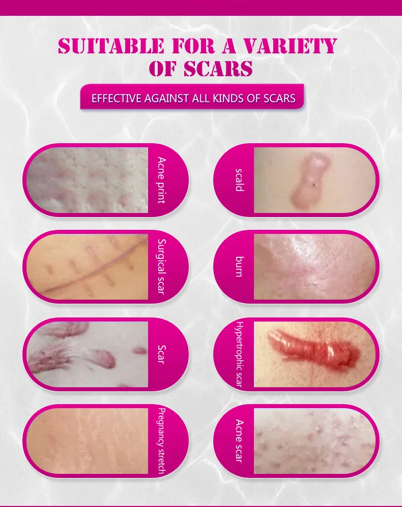 Tyjr 15g Natural Chinese Medicine Scar Repair Cream Postpartum Obesity ...