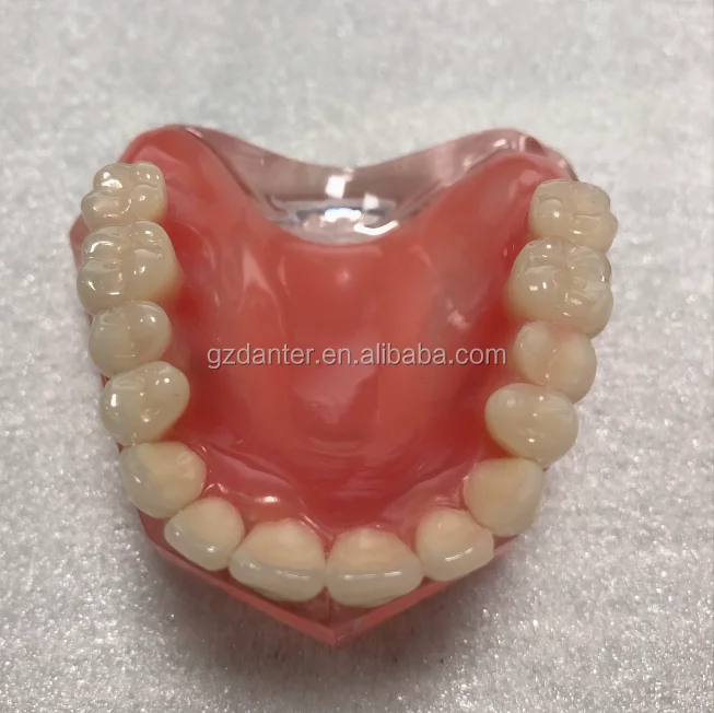 Educatief Bovenste Onderkaak Implant Model Tanden Overkappingsprothese ...