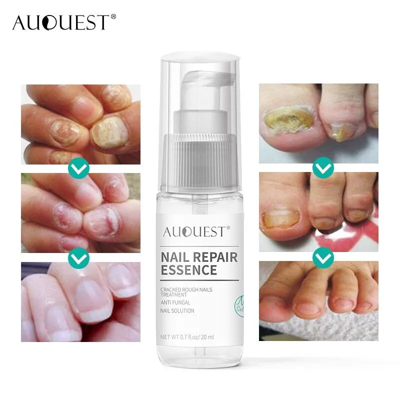 Quick Effect Nail Solution Nail Repair Serum / Cracked Rough Nails ...
