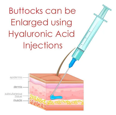 Medical And Cosmetic Grade Hydrogel Butt Injections For Sale Buttocks ...