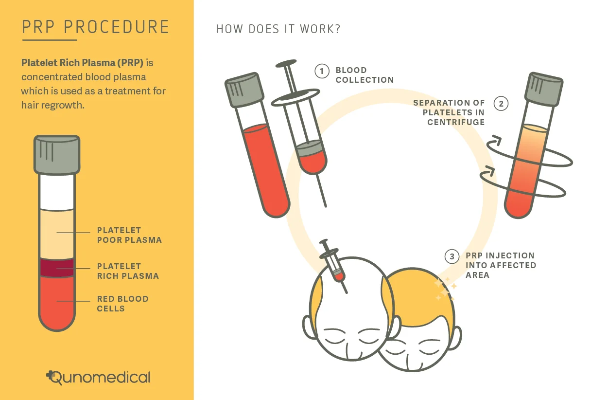 Hot Sale Bd Prp Tube Regen Lab Prp Tube Prp Tube With Hyaluronic Acid ...