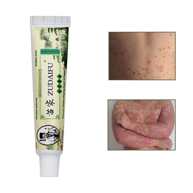 Zudaifu Skin Care Cream Skin Psoriasis Cream Dermatitis Eczematoid ...