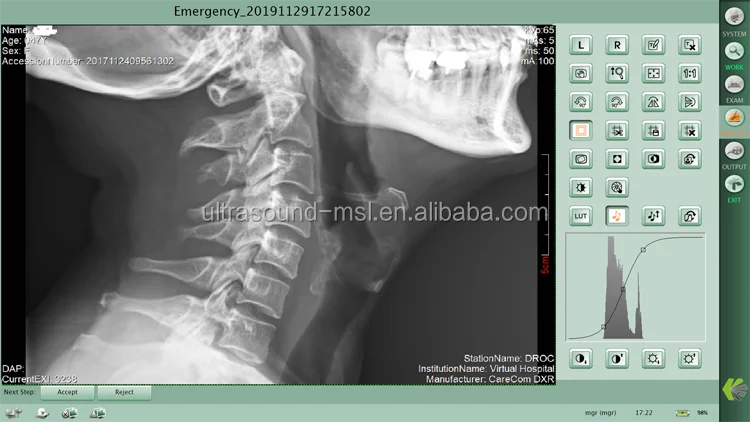 DR FPD X-Ray Imaging - 14X17 Digital Flat Panel Detector