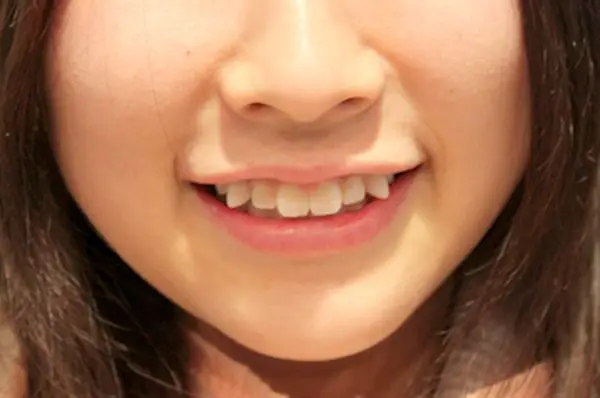 Japan's Crooked Teeth Trend: Cultural Significance & Modern Practices