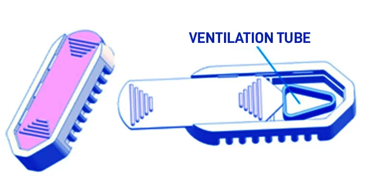 T-tube Ventilation Tube - Buy Tympanostomy Tube,Grommet,Myringotomy ...