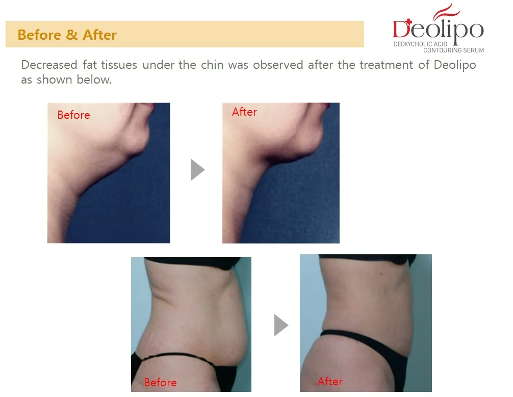 Deoxycholic Acid Face Contour & Lipolysis Injection "deolipo(kabelline)" - Buy Deoxycholic Acid ...